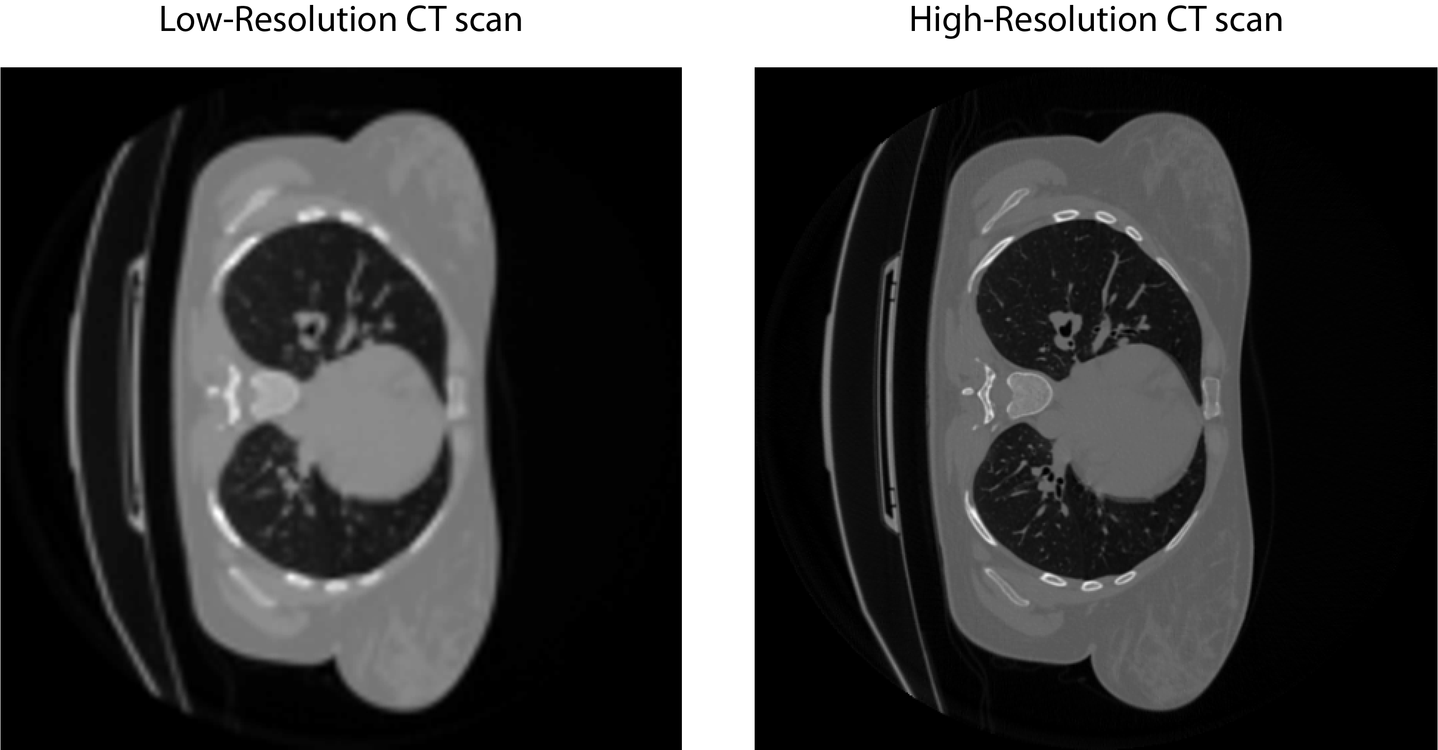 CT super-resolution using Generative Adversarial Network