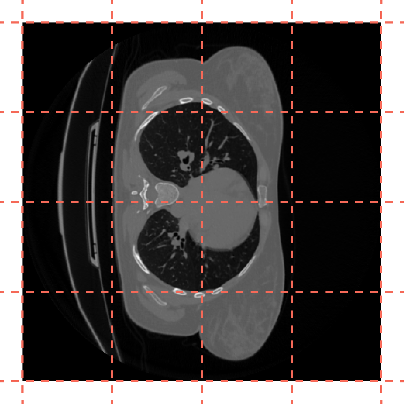 CT super-resolution using Generative Adversarial Network