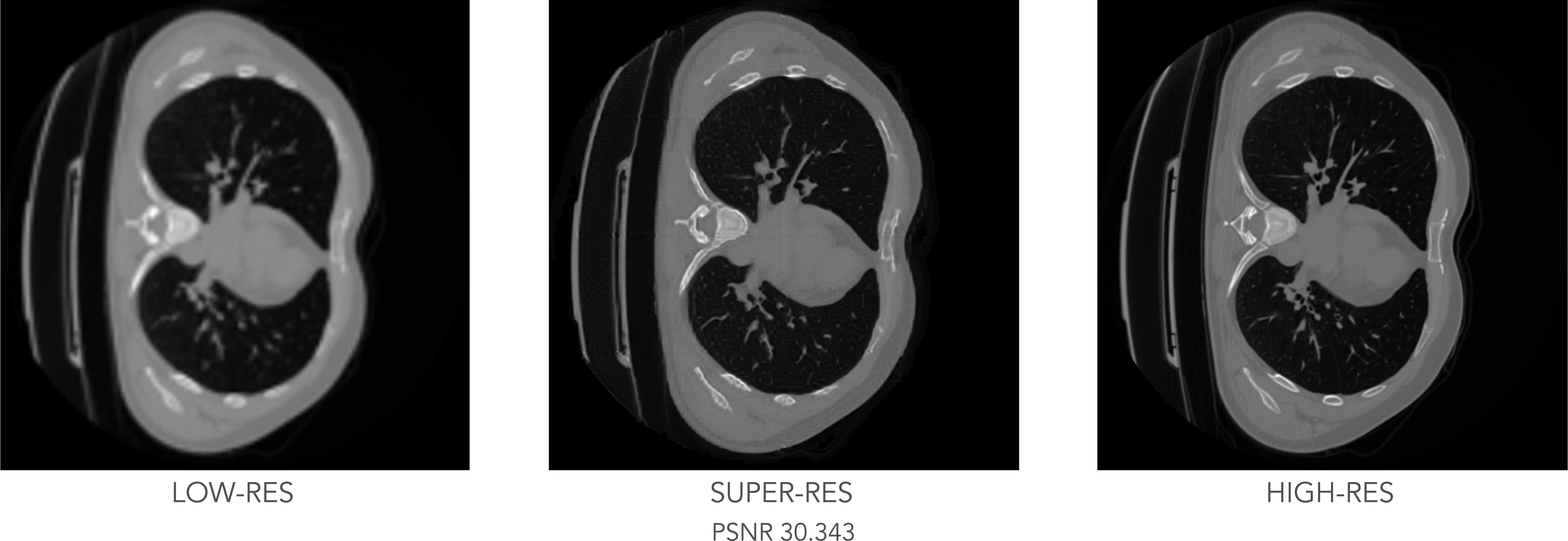 CT super-resolution using Generative Adversarial Network